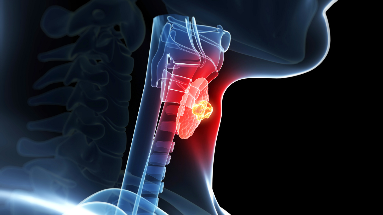 Un nuevo tratamiento puede curar más rápido el cáncer de garganta ...